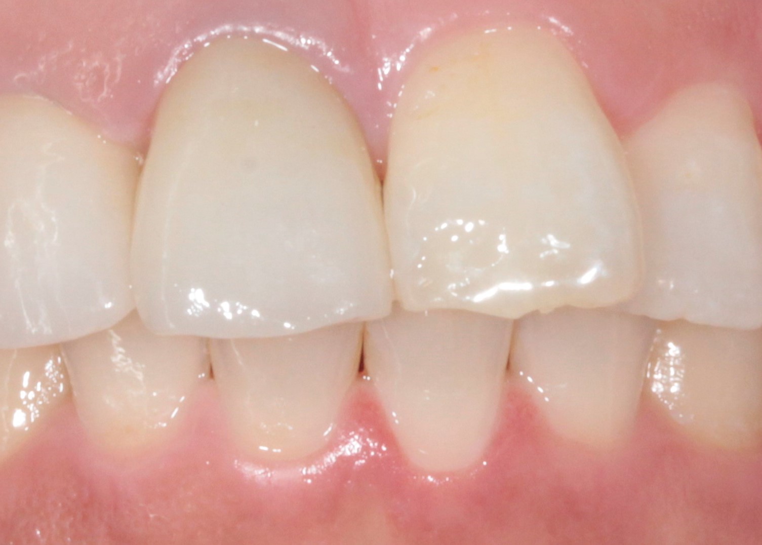 審美歯科（オールセラミックス）の治療例 - よしだ・ファミリー・歯科｜元住吉の歯医者なら、駅徒歩3分、土日も診療で通いやすい、よしだ・ファミリー・歯科