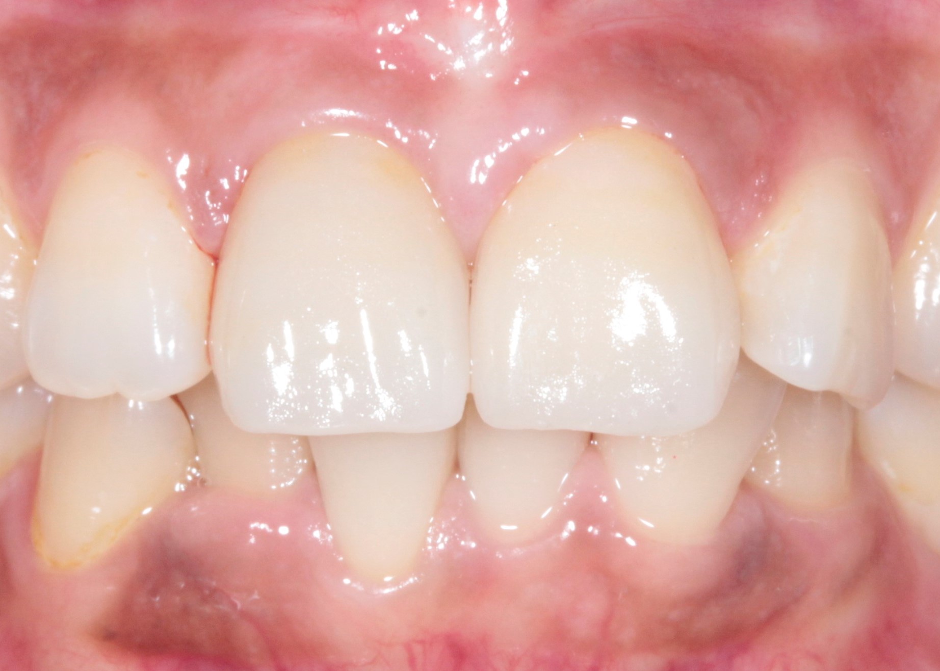 審美歯科（オールセラミックス）の治療例 - よしだ・ファミリー・歯科｜元住吉の歯医者なら、駅徒歩3分、土日も診療で通いやすい、よしだ・ファミリー・歯科