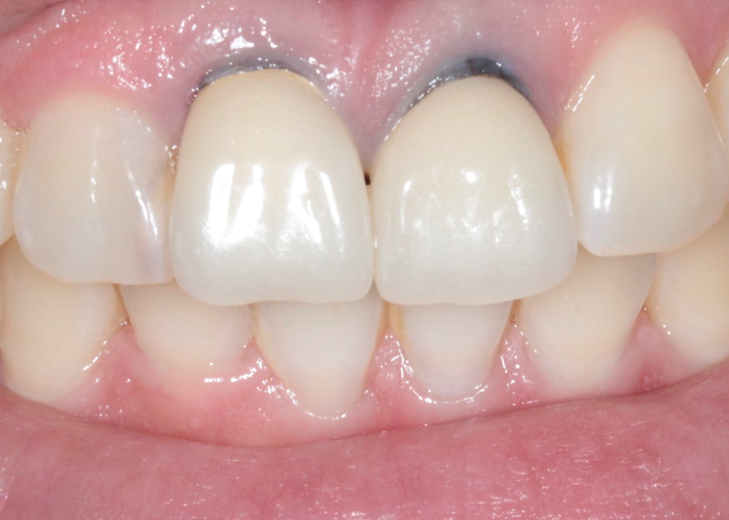 審美歯科（オールセラミックス）の治療例 - よしだ・ファミリー・歯科｜元住吉の歯医者なら、駅徒歩3分、土日も診療で通いやすい、よしだ・ファミリー・歯科